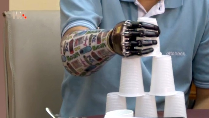 Prvi je put u ovom dijelu Europe ugrađena inteligentna proteza ruke ...